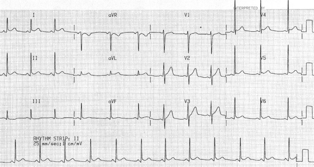 Pericarditis ECG Changes • LITFL • ECG Library Diagnosis