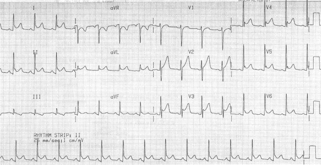 Pericarditis ECG Changes • LITFL • ECG Library Diagnosis