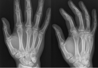 Bennett fracture • LITFL • Medical Eponym Library