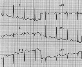 ECG Axis Interpretation • LITFL • ECG Library Basics