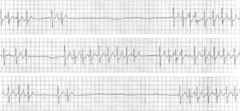 Sinus Node Dysfunction (Sick Sinus Syndrome) • LITFL • ECG Library