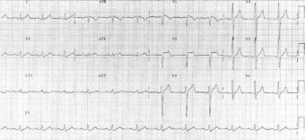 Brugada Syndrome • LITFL • ECG Library Diagnosis