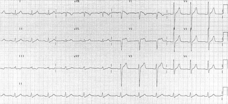 Brugada Syndrome • LITFL • ECG Library Diagnosis