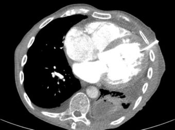 Cardiovascular Curveball • LITFL Clinical Cases • Misplaced ICC