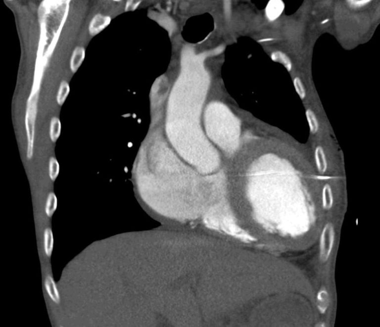 Cardiovascular Curveball • LITFL Clinical Cases • Misplaced ICC