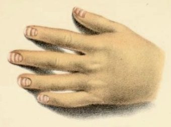 Mees lines • LITFL • Medical Eponym Library