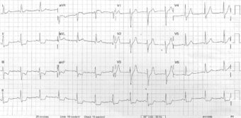 De Winter T Wave • LITFL • ECG Library Diagnosis