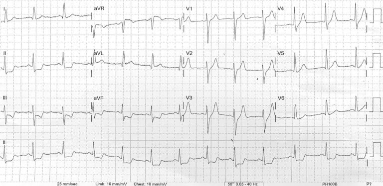 De Winter T Wave • LITFL • ECG Library Diagnosis