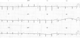 Dextrocardia • LITFL • ECG Library Diagnosis