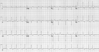 Digoxin Effect • LITFL • ECG Library Toxicology