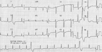 Digoxin Effect • LITFL • ECG Library Toxicology