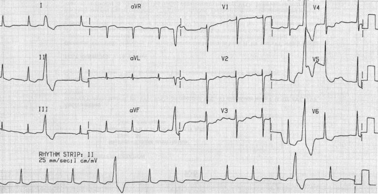 Digoxin Effect • LITFL • ECG Library Toxicology