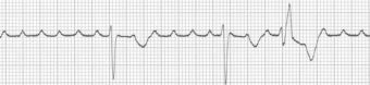 Digoxin Toxicity • LITFL • ECG Library Toxicology