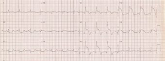 Anterior Myocardial Infarction • LITFL • ECG Library Diagnosis