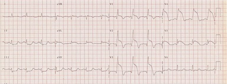 Anterior Myocardial Infarction • LITFL • ECG Library Diagnosis