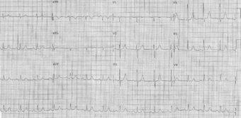 ECG Case 078 • LITFL • ECG Top 100 Self-Assessment Quiz