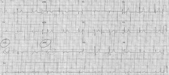 ECG Case 078 • LITFL • ECG Top 100 Self-Assessment Quiz