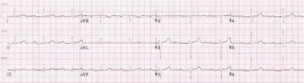 First Degree Heart Block • LITFL • ECG Library Diagnosis