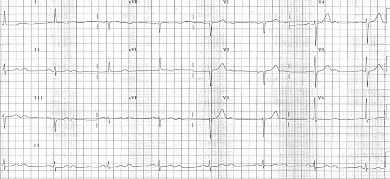 AV block: 2nd degree, “fixed ratio” blocks • LITFL • ECG Library Diagnosis