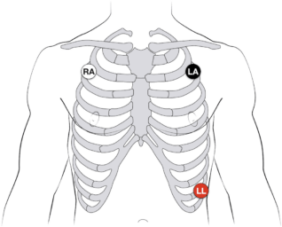 ECG Lead positioning • LITFL • ECG Library Basics