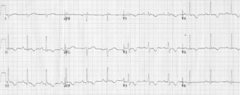 Right Ventricular Hypertrophy (RVH) • LITFL • ECG Library Diagnosis