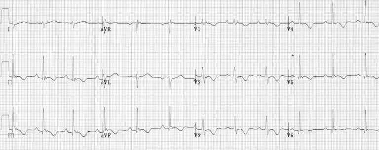 Right Ventricular Hypertrophy (RVH) • LITFL • ECG Library Diagnosis