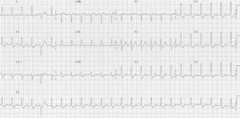 The ST Segment • LITFL • ECG Library Basics