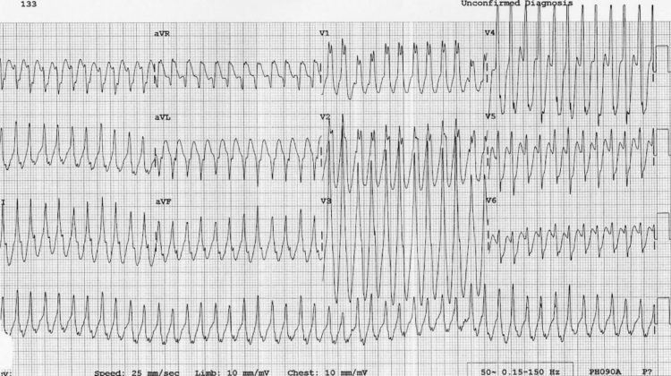 VT versus SVT • LITFL Medical Blog • ECG Library Basics