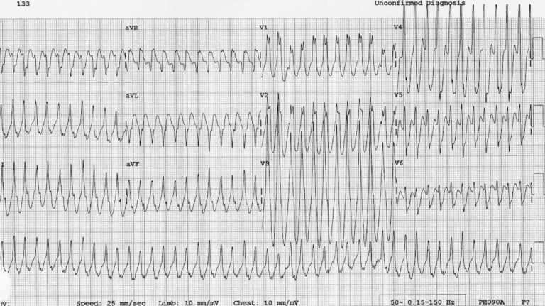 VT versus SVT • LITFL Medical Blog • ECG Library Basics