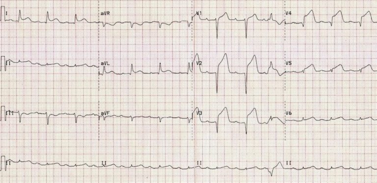 The ST Segment • LITFL • ECG Library Basics