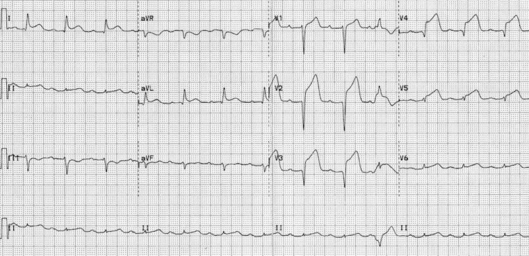 Anterior Myocardial Infarction • LITFL • ECG Library Diagnosis