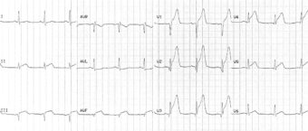 Anterior Myocardial Infarction • LITFL • ECG Library Diagnosis