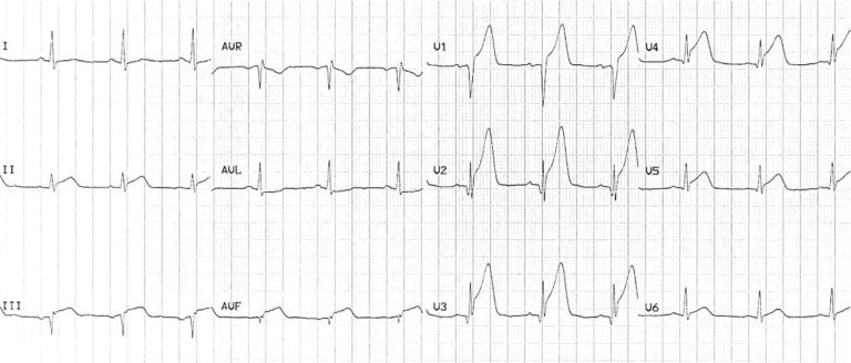 Anterior Myocardial Infarction • LITFL • ECG Library Diagnosis