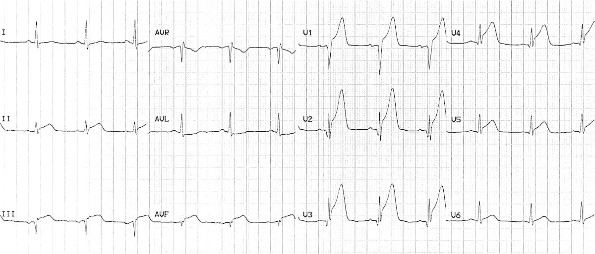What Is Anterior St Elevation - Design Talk