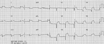 Lateral STEMI ECG changes • LITFL • ECG Library Diagnosis