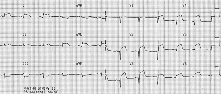 Lateral STEMI ECG changes • LITFL • ECG Library Diagnosis