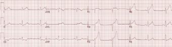 Lateral STEMI ECG changes • LITFL • ECG Library Diagnosis