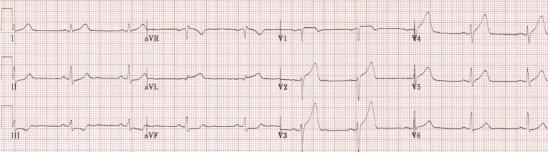 Lateral STEMI ECG changes • LITFL • ECG Library Diagnosis