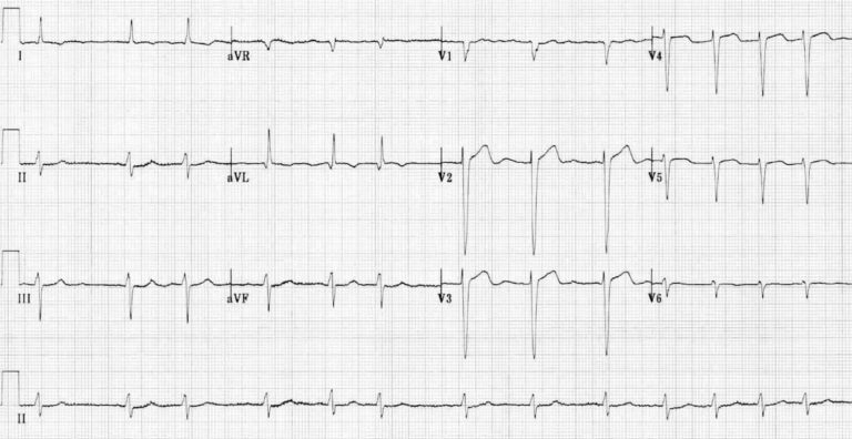 Atrial Flutter Litfl Ecg Library Diagnosis