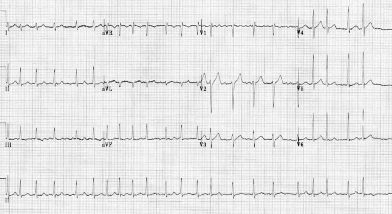 Atrial Fibrillation • LITFL • ECG Library Diagnosis