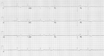 Atrial Fibrillation • LITFL • ECG Library Diagnosis