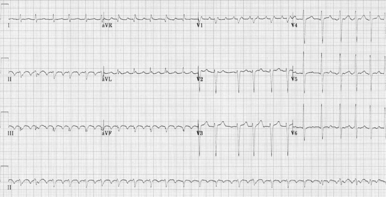 Atrial Flutter • LITFL • ECG Library Diagnosis