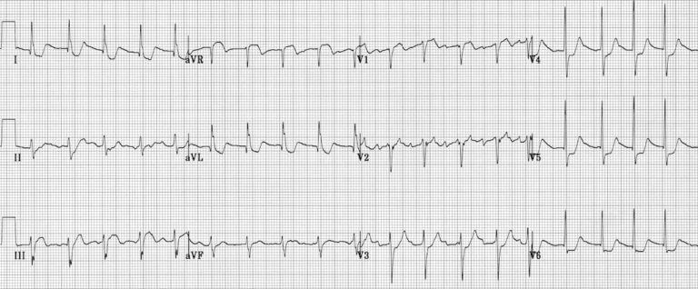 ST Elevation in aVR • LITFL • ECG Library Diagnosis