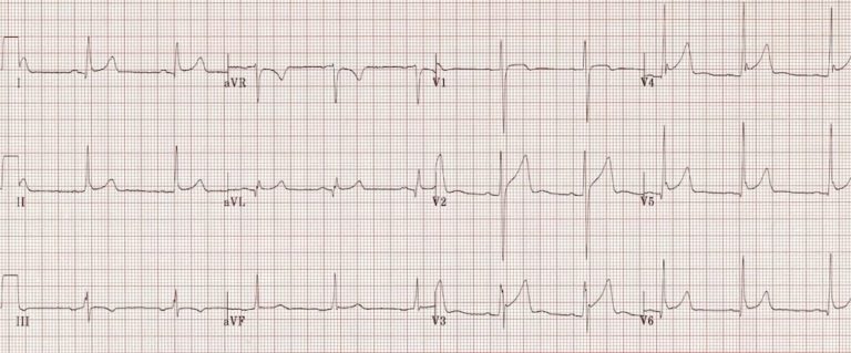 The ST Segment • LITFL • ECG Library Basics