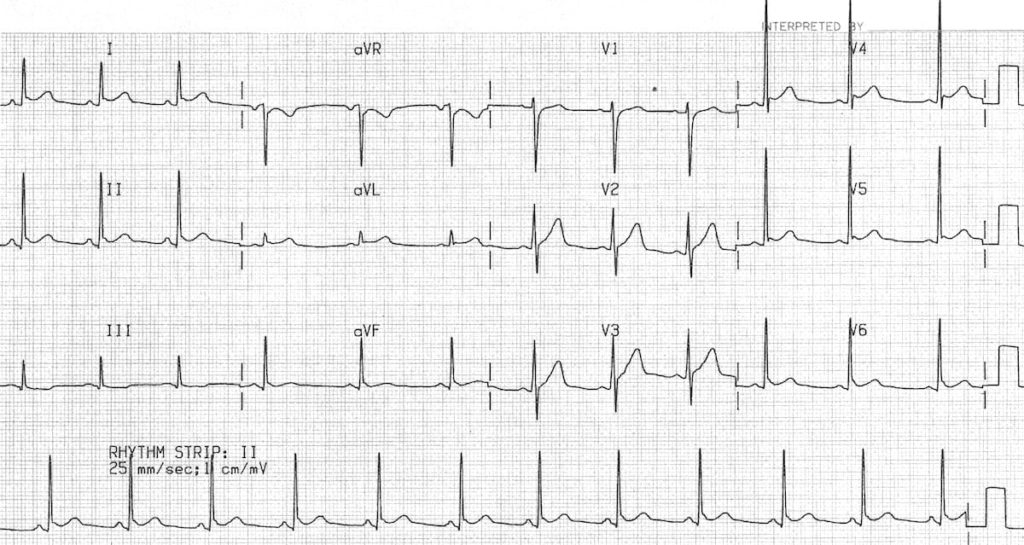 Benign Early Repolarisation • LITFL • ECG Library Diagnosis