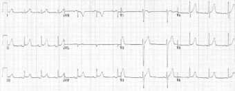 Benign Early Repolarisation • LITFL • ECG Library Diagnosis