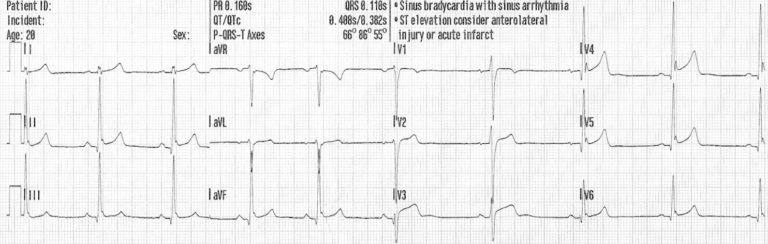 Benign Early Repolarisation • LITFL • ECG Library Diagnosis