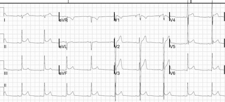 Benign Early Repolarisation • LITFL • ECG Library Diagnosis