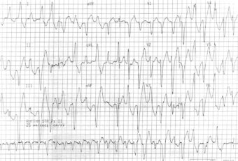Bidirectional Ventricular Tachycardia (BVT) • LITFL • ECG Library