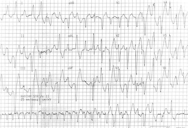 Bidirectional Ventricular Tachycardia (BVT) • LITFL • ECG Library